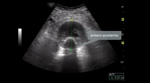 Normal Colour Doppler Flow Appearance Of An AAA After Endovascular ...