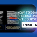 Left “Mickey Mouse” Sign And Deep Vein Thrombosis - ABC Vascular