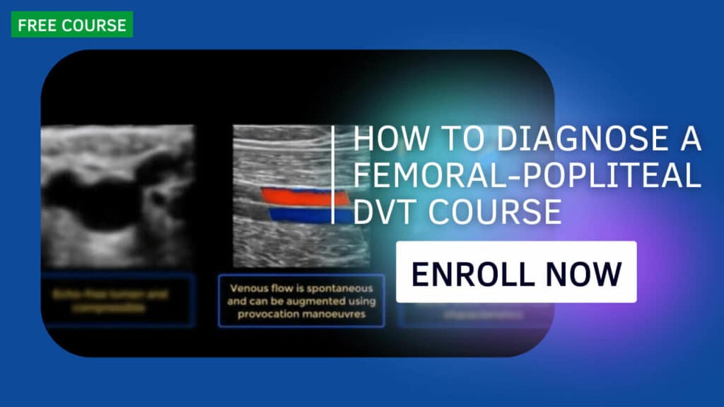 Left “Mickey Mouse” Sign And Deep Vein Thrombosis - ABC Vascular