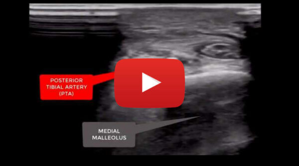 Calcified Occlusion Of The Posterior Tibial Artery: Tips For Ultrasound ...