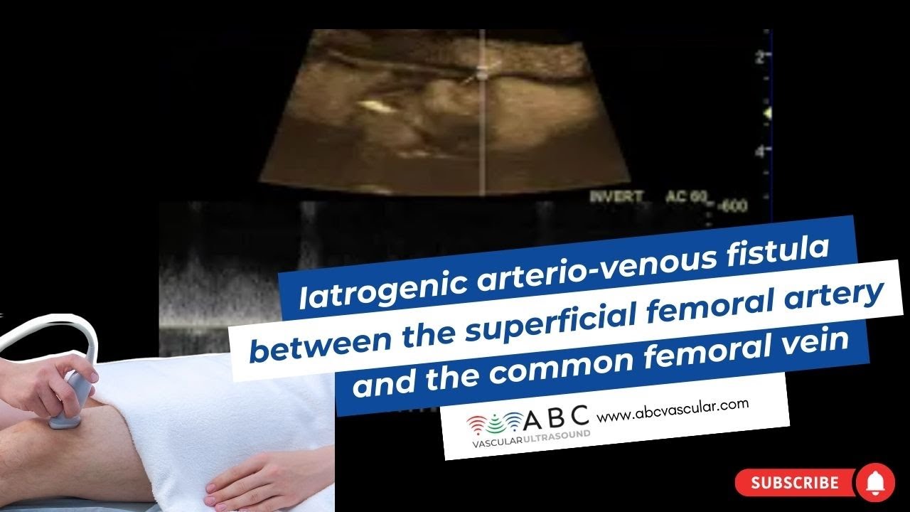 Iatrogenic Arterio-Venous Fistula Between The Superficial Femoral ...