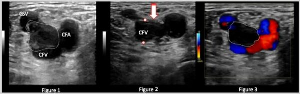 Left “Mickey Mouse” Sign And Deep Vein Thrombosis - ABC Vascular