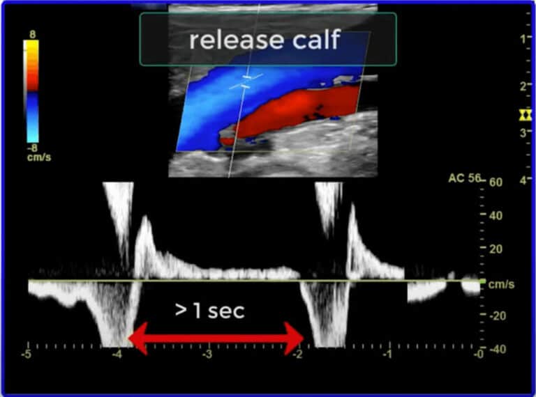 Deep Vein Thrombosis: Ultrasound Criteria & Diagnostic Skills For ...