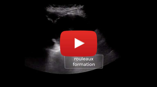 Rouleaux Formation In An Abdominal Aortic Aneurysm - ABC Vascular